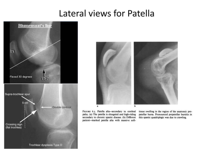 Patella dislocations | PPTX