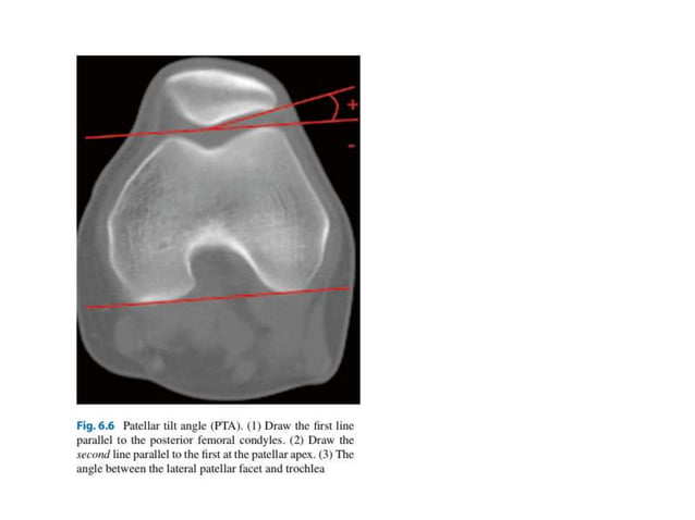 Patella dislocations | PPTX