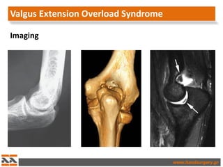 Elbow sports injuries | PPT | Free Download