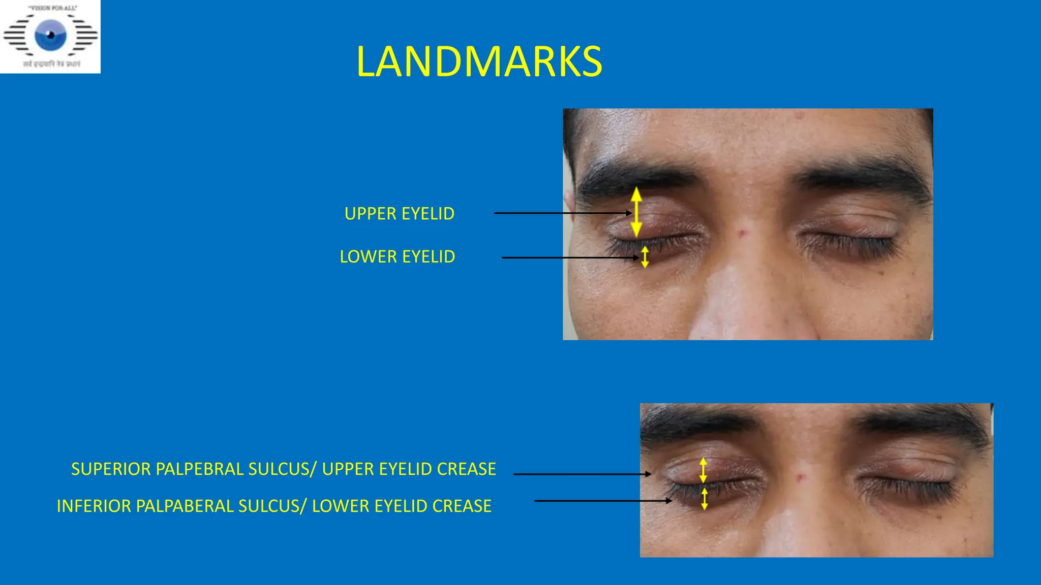 EYELID_ANATOMY presentation dhir bwn.pptx