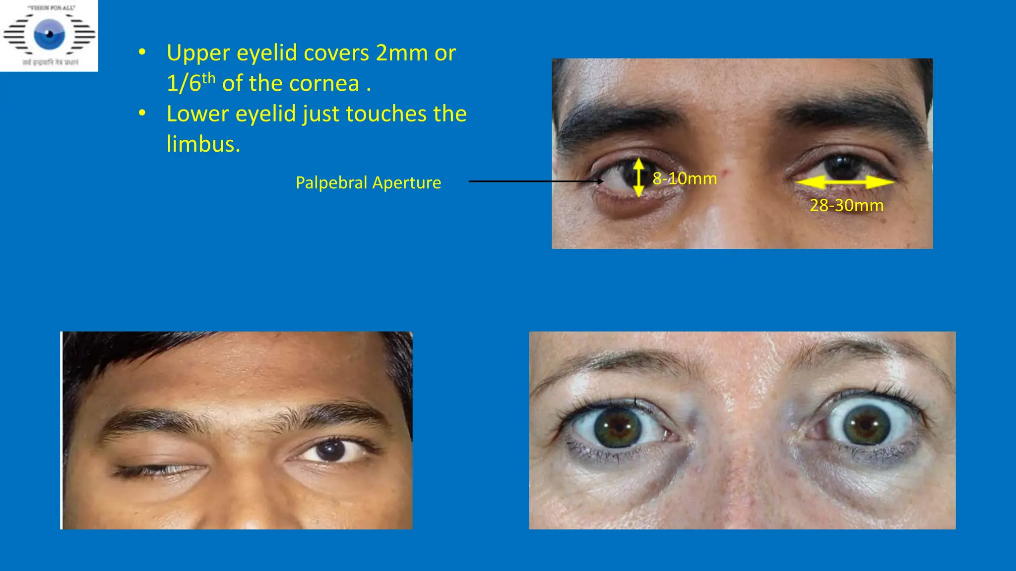 EYELID_ANATOMY presentation dhir bwn.pptx