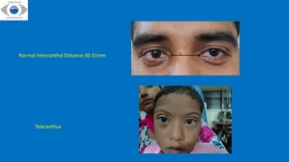 EYELID_ANATOMY presentation dhir bwn.pptx