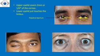 EYELID_ANATOMY presentation dhir bwn.pptx