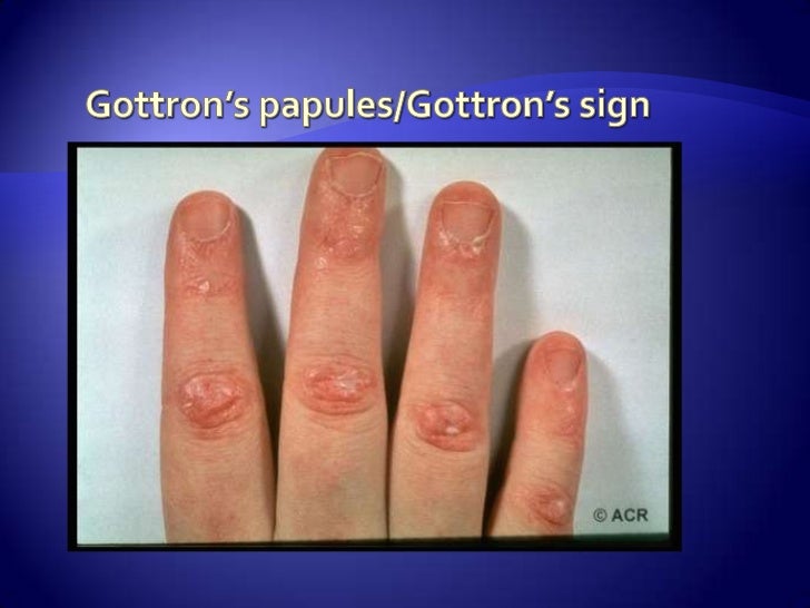 Other Pediatric Rheumatic DIseases