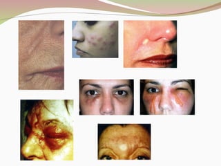 Filler Jenis Indikasi Komplikasi dan Penangannanya Part Two | PPT