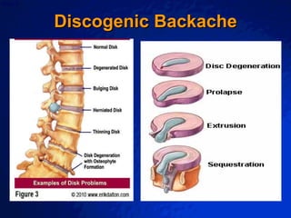Percutaneous Discectomy by Dr Ashok Jadon | PPT