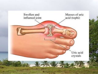 juvenile and gouty arthritis | PPT
