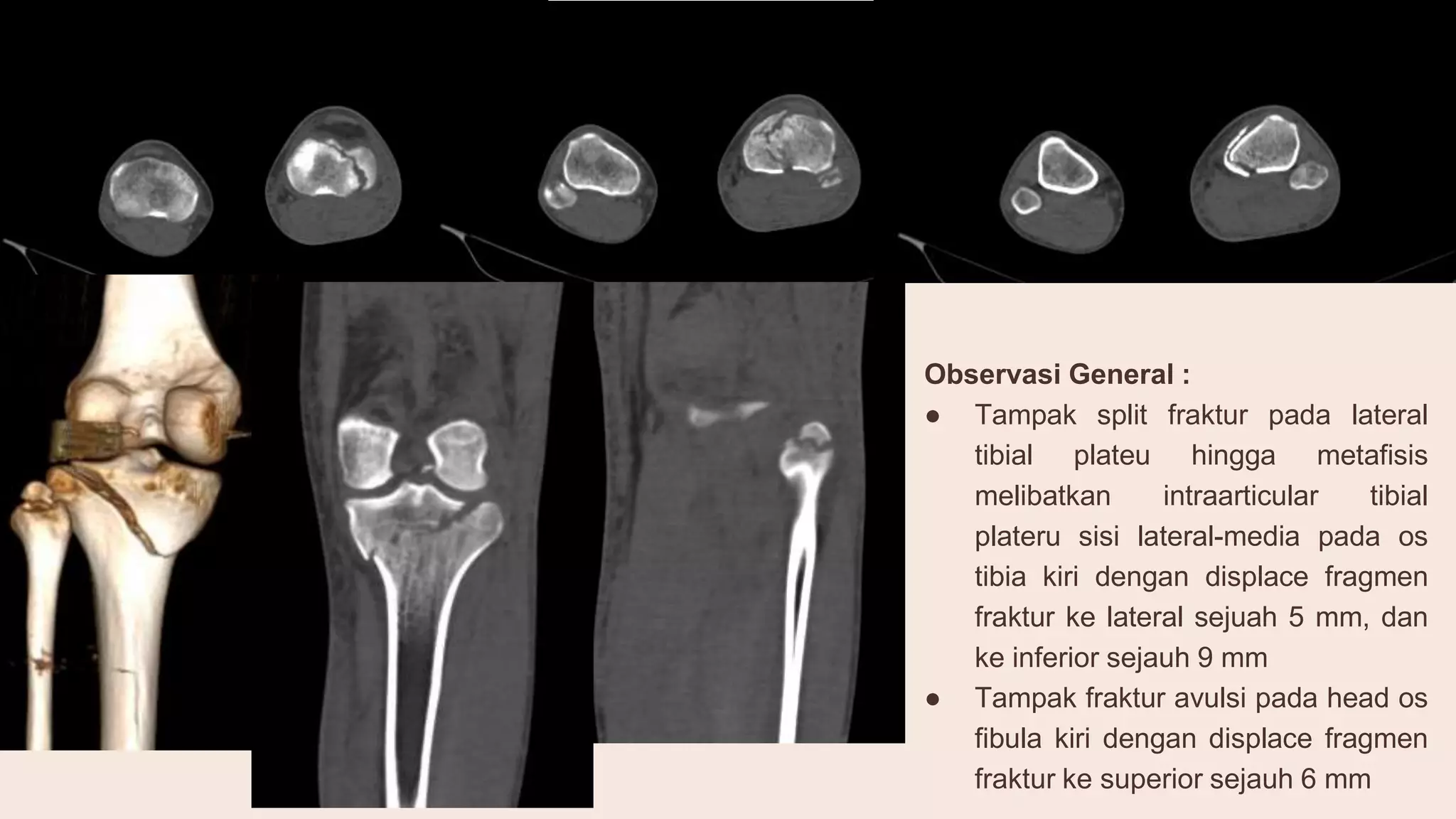 Fraktur Tibia Plateu.pptx