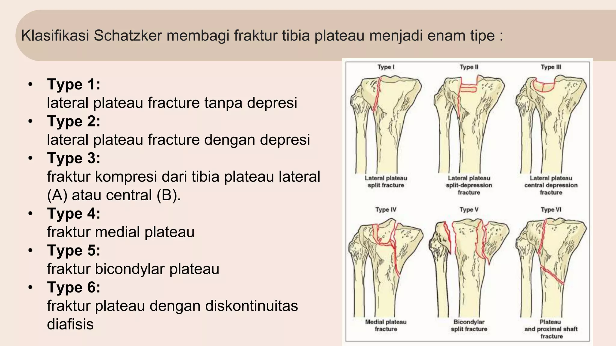 Fraktur Tibia Plateu.pptx