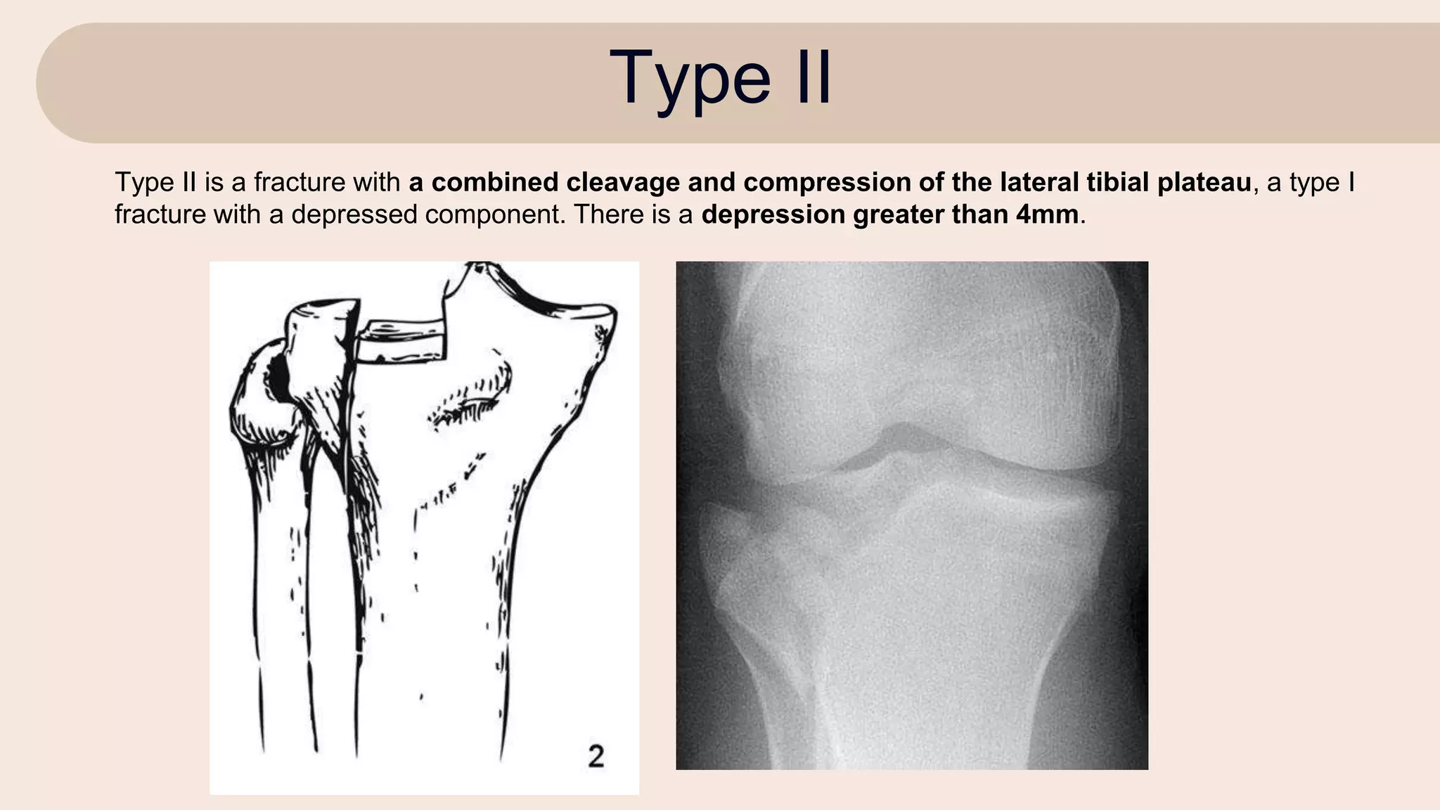 Fraktur Tibia Plateu.pptx
