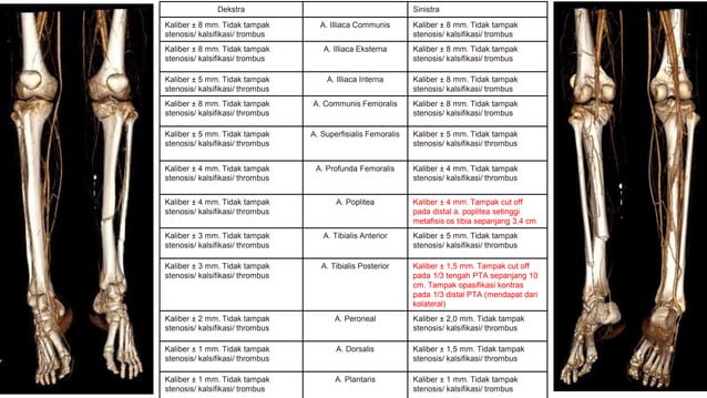 Fraktur Tibia Plateu.pptx | Death, Injury, or Military Conflict ...