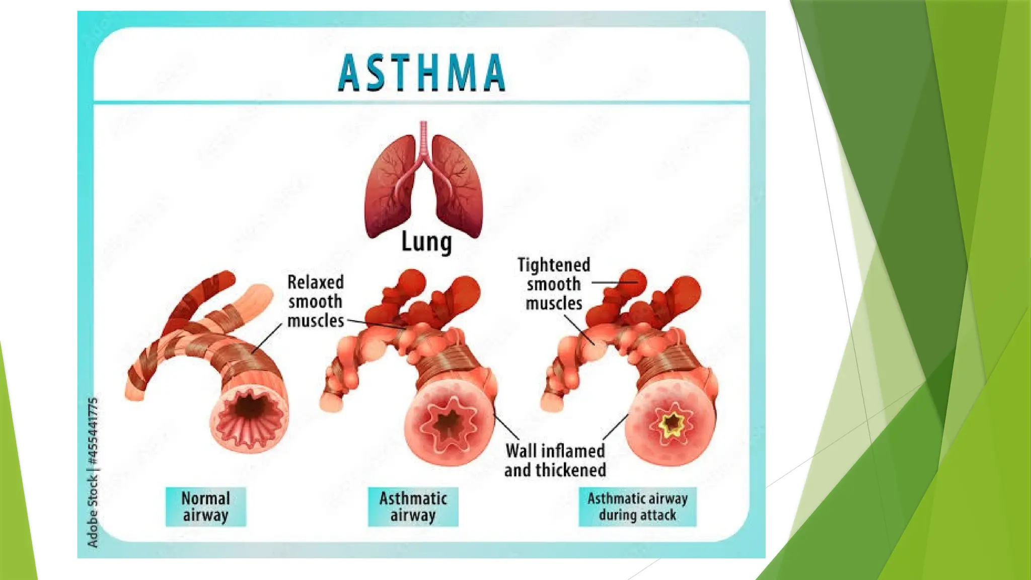 Breathless Battles: Understanding Asthma Pathophysiology | PPTX
