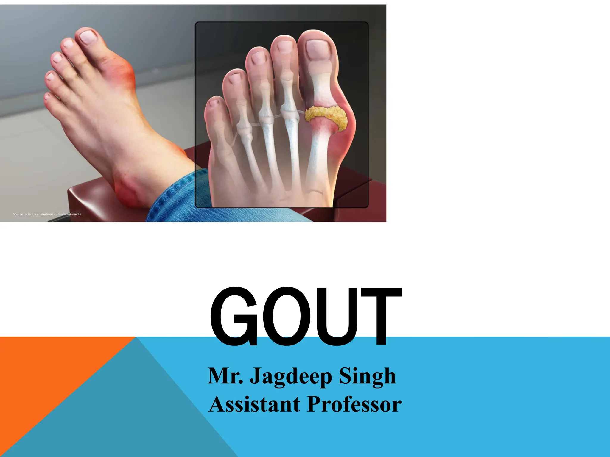 Pathophysiology of Gout: Unraveling the Mechanisms Behind the Crystal-Induced Joint Disorder | PPTX