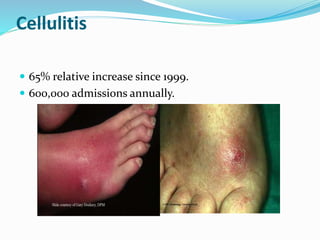 Skin and Soft Tissue Infections | PPTX