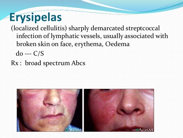 Skin and Soft Tissue Infections