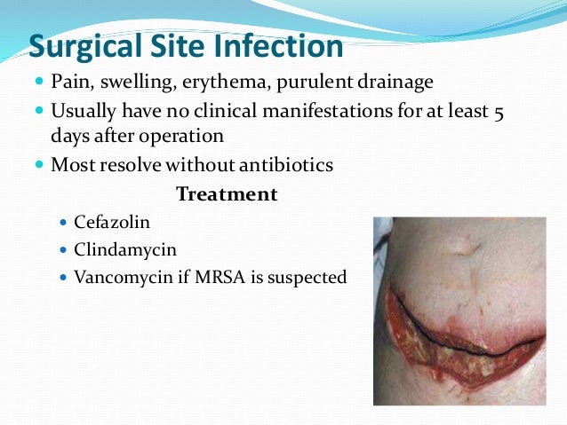 Skin and Soft Tissue Infections