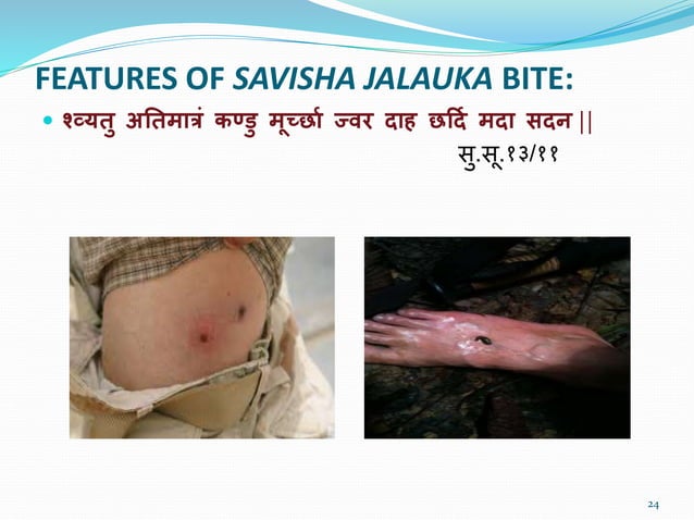 Jalaukavacharana - Leech Therapy in Ayurveda | PPTX | Blood Disorders ...