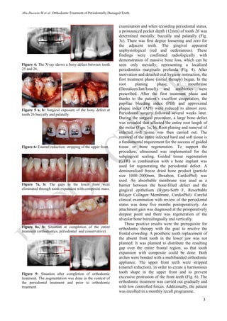 ORTHODONTIC TREATMENT OF PERIODONTALLY DAMAGED TEETH - AN ...