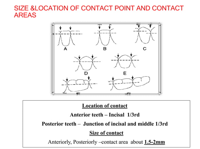 CONTACTS AND CONTOURS IN DENTISTRY | PPTX | Dental Health | Diseases and Conditions