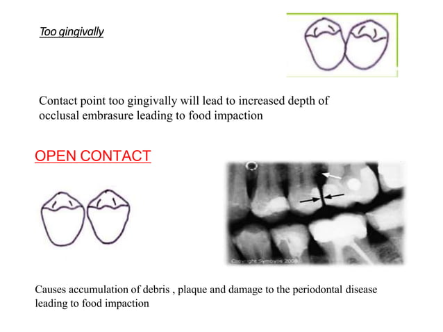 CONTACTS AND CONTOURS IN DENTISTRY | PPTX | Dental Health | Diseases ...