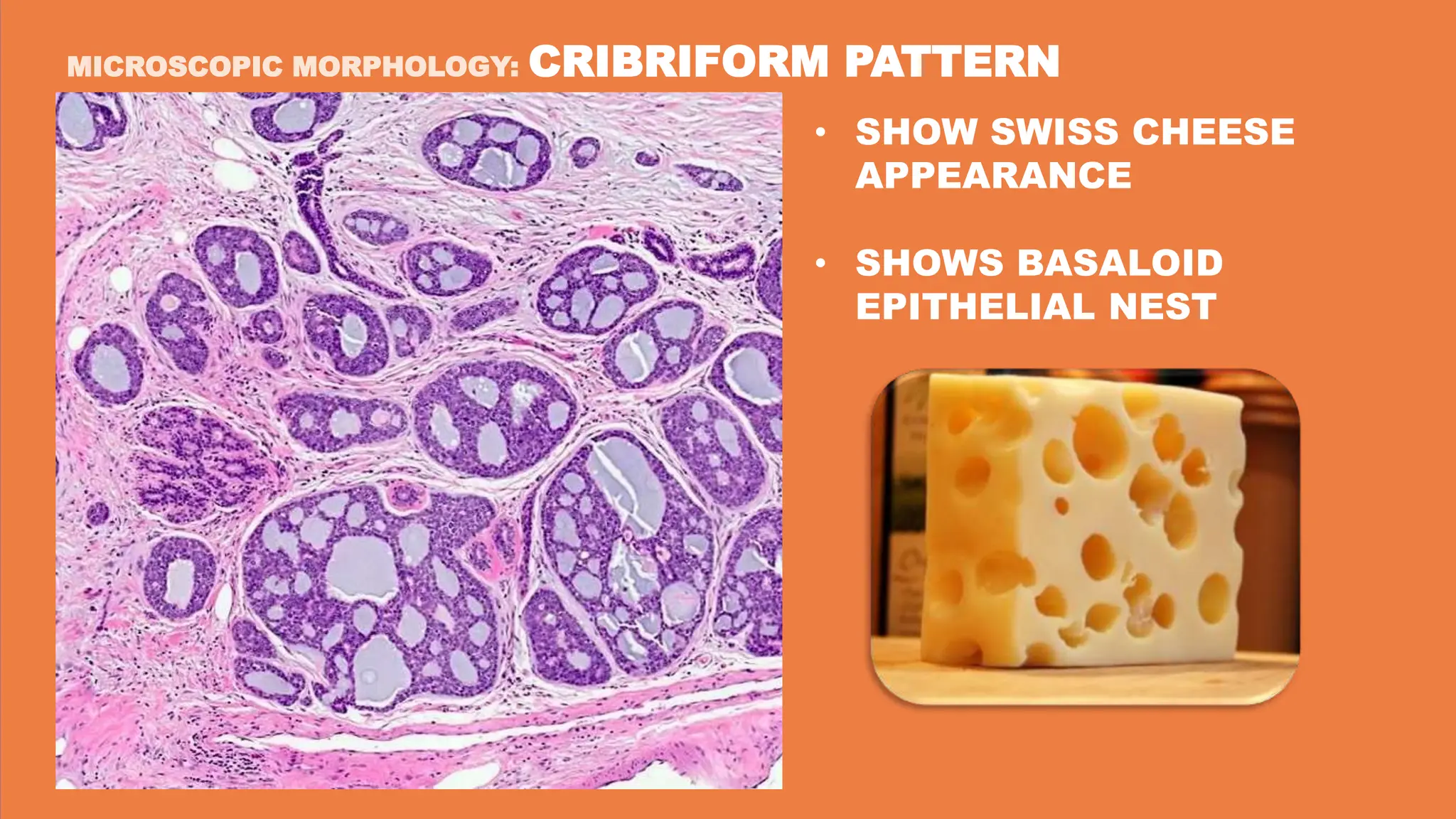 Malignant Salivary Gland Tumor and it's pathology. | PPTX
