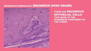 Malignant Salivary Gland Tumor and it's pathology. | PPTX