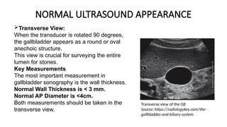 SONOGRAPHIC EVALUATION OF NORMAL GALLBLADDER AND CHOLECYSTITIS | PPTX