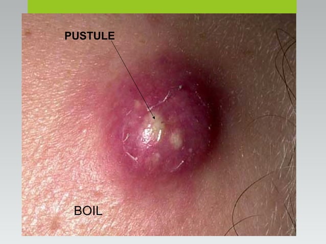 JANGKITAN - ABCESS, BOIL, SINUS, FISTULA & FISSURE | PPT