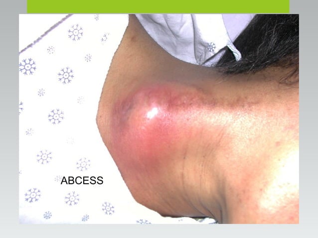 JANGKITAN - ABCESS, BOIL, SINUS, FISTULA & FISSURE | PPT