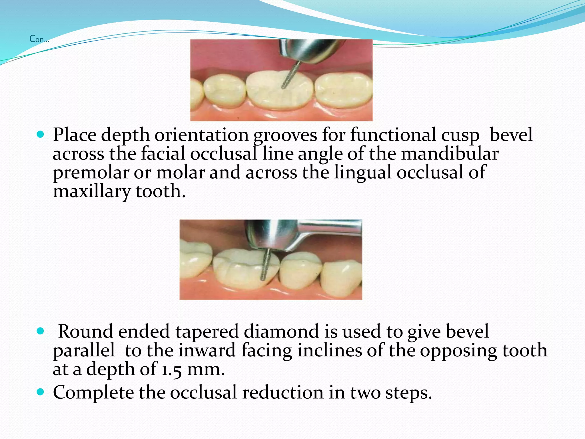 complex restorations | PPTX