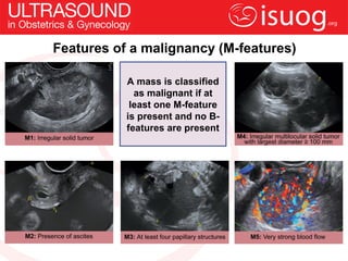 UOG Journal Club: Improving strategies for diagnosing ovarian cancer: a ...