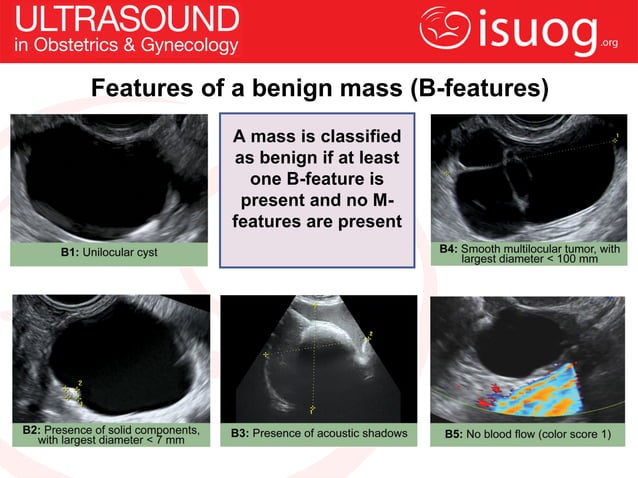 UOG Journal Club: Improving strategies for diagnosing ovarian cancer: a ...