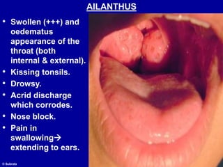 JANUARY 2015-TONSIL.ppt