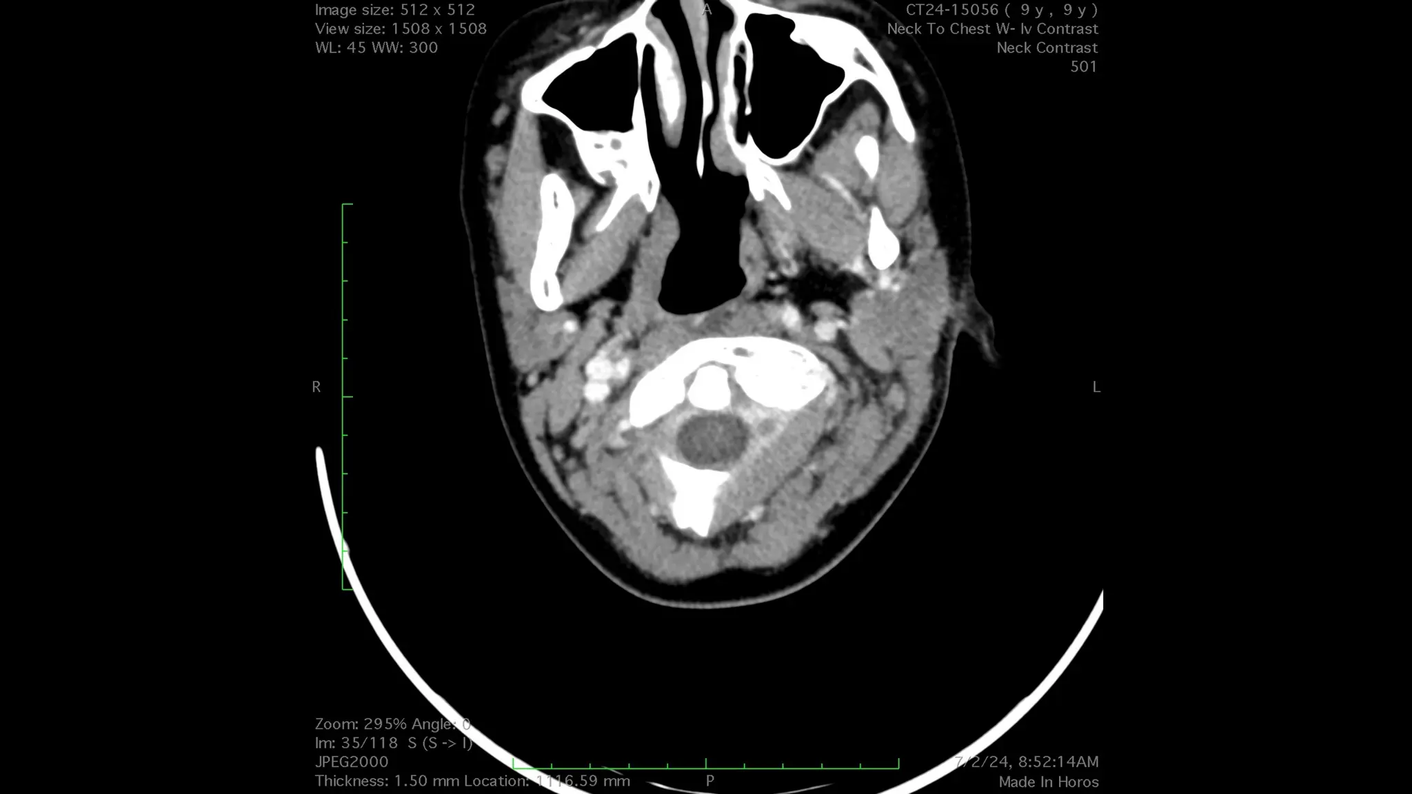 Neck to Chest CT with Contrast Imaging.pptx
