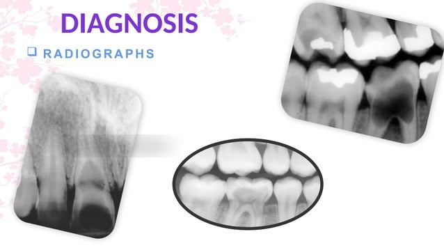 pink tooth.pptx BDS PEDODONTICS J .K .K N | PPTX