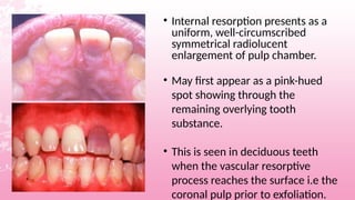 pink tooth.pptx BDS PEDODONTICS J .K .K N | PPTX