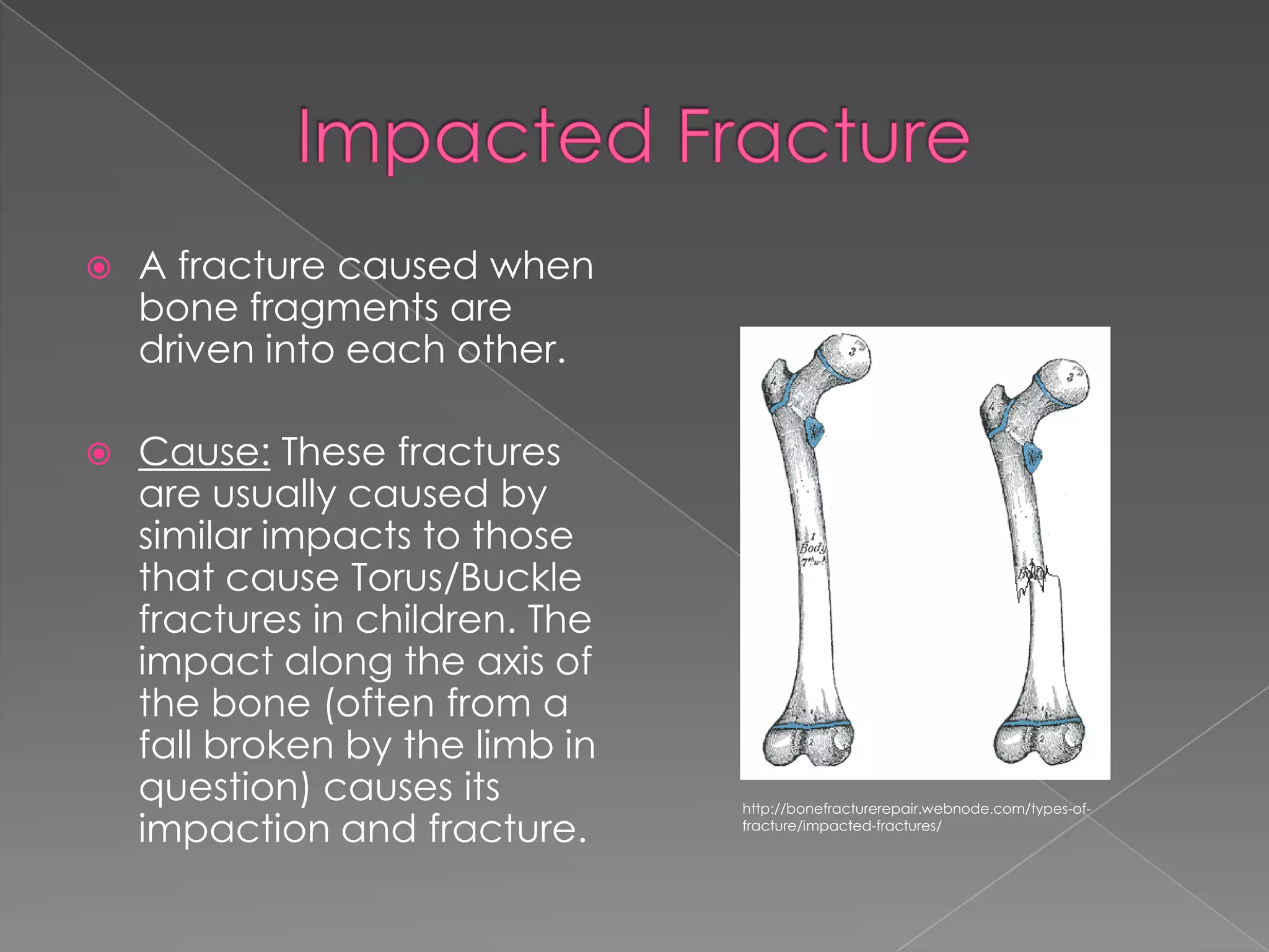 Jason godo biology 120 chapter 4 presentation fracture types | PPTX ...