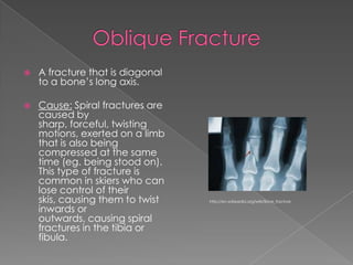 Jason godo biology 120 chapter 4 presentation fracture types | PPTX ...