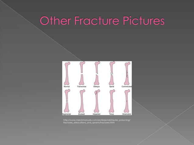 Jason godo biology 120 chapter 4 presentation fracture types | PPTX ...