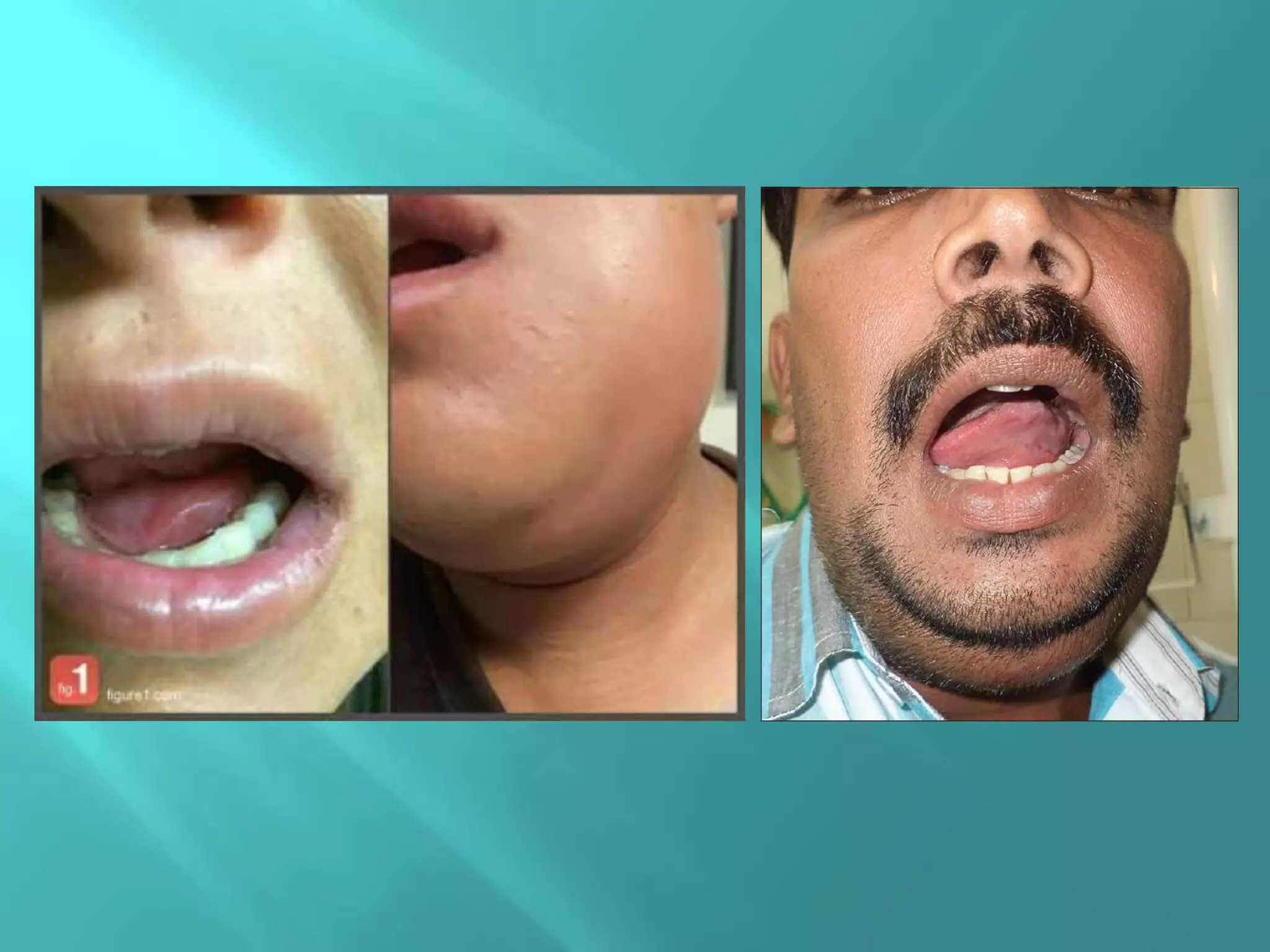 Ludwig's Angina | PPTX