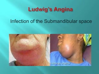 Ludwig's Angina | PPTX