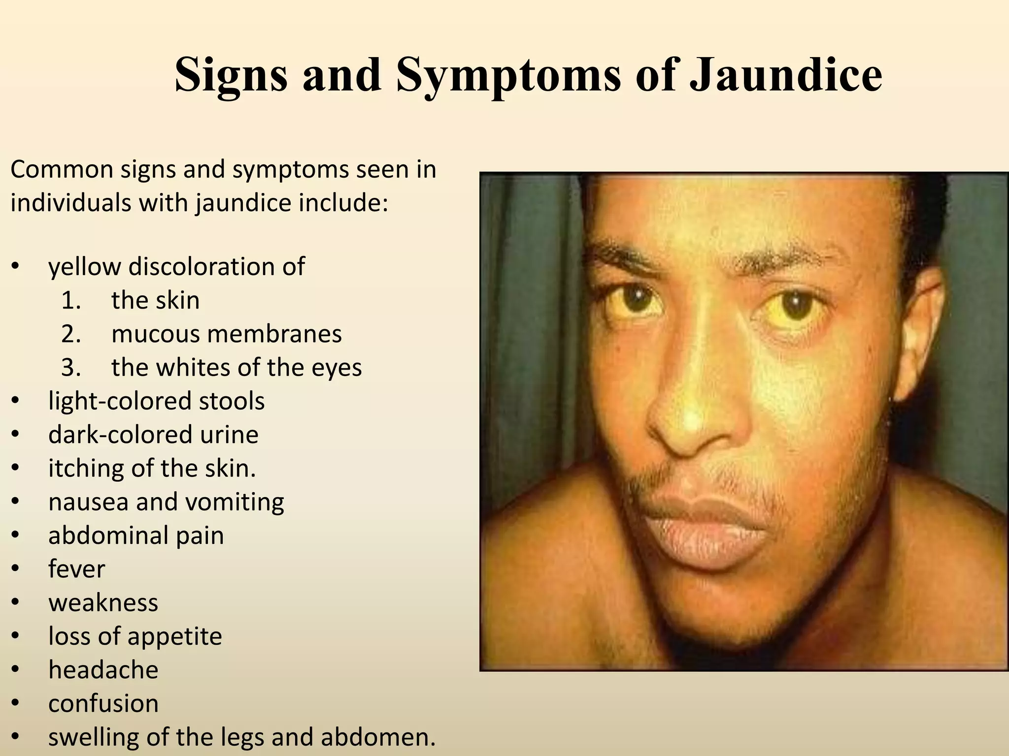 Jaundice | PPTX