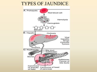 Jaundice | PPTX