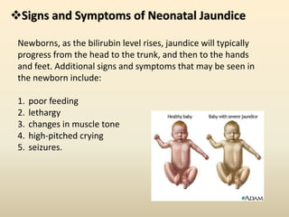 All about Jaundice | PPTX