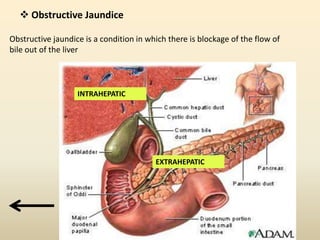 All about Jaundice | PPTX