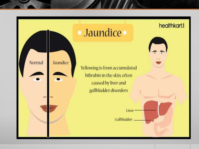 Jaundice | PPTX