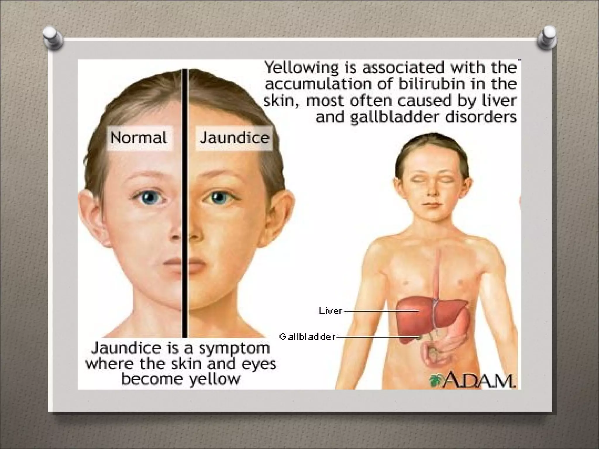 Jaundice | PPT