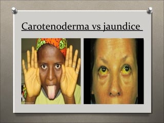 Carotenodermia