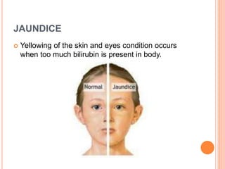 Jaundice and hepatitis B | PPTX