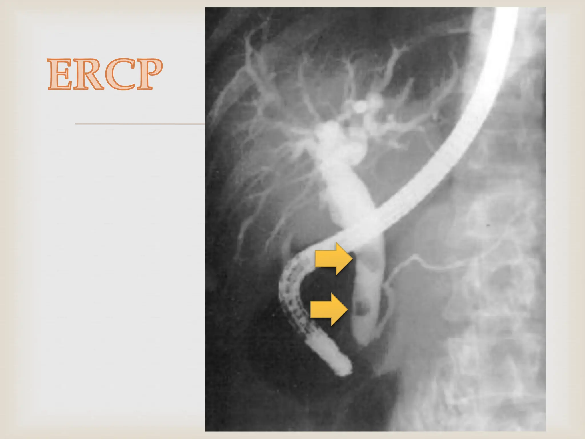 jaundice-(three types)- pre hepatic, hepatic , post hepatic | PDF